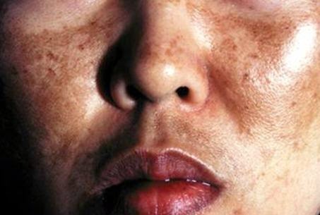 ¿Conoces El Cloasma?