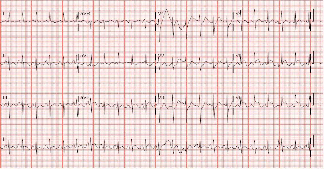 ACLS review: Acute Coronary Syndromes Part 5