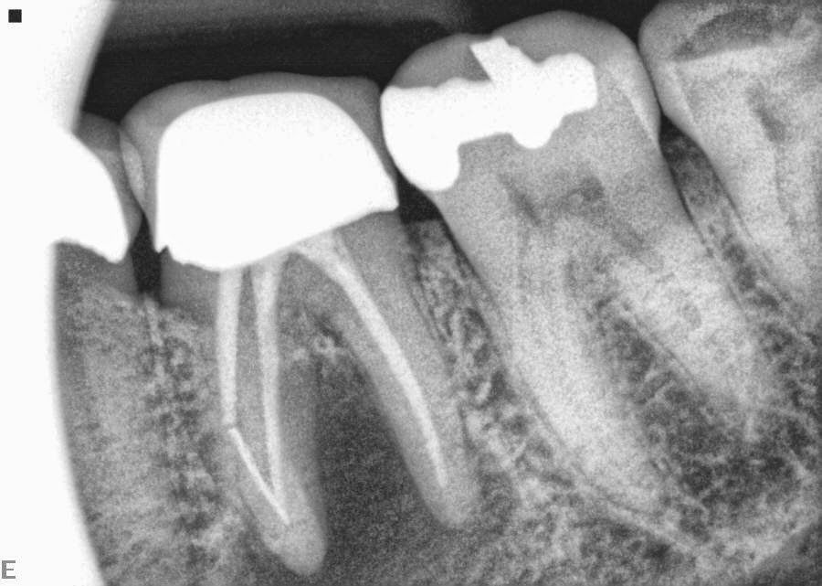 Boyd4Endo: Case 35 Apicoectomy vs. Orthograde Retreatment