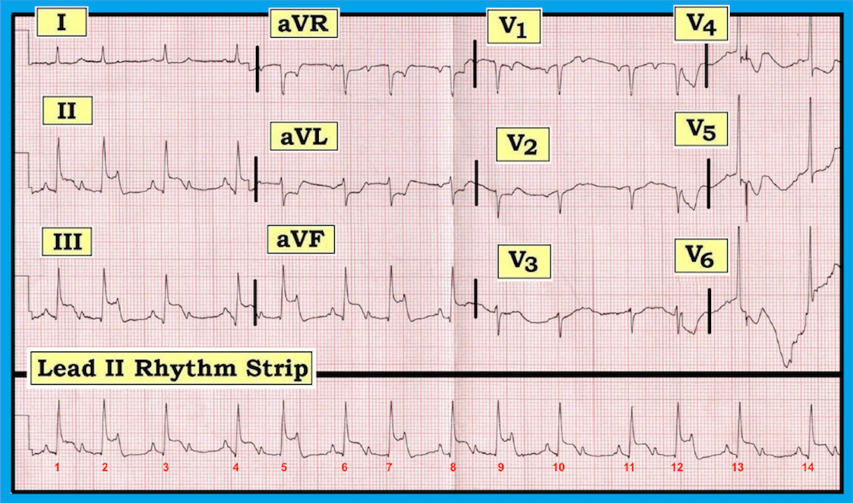Rhythm Strip Mobitz Type 1
