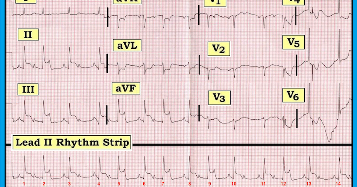 ECG Interpretation: ECG Blog #154 (STEMI - Inferior - Posterior - LVH ...