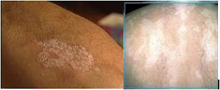 sikkahoder: mengenal berbagai bentuk kelainan pada kulit