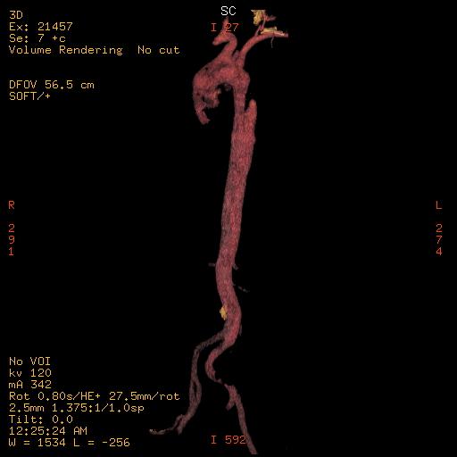 X-RAYview: Dissecção da AORTA