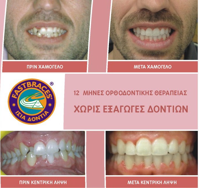 The Sekouratoi: ΟΡΘΟΔΟΝΤΙΚΗ (ΙΣΙΑ ΔΟΝΤΙΑ) ΣΕ ΛΙΓΟΤΕΡΟ ΧΡΟΝΟ ΚΑΙ ΧΩΡΙΣ ...