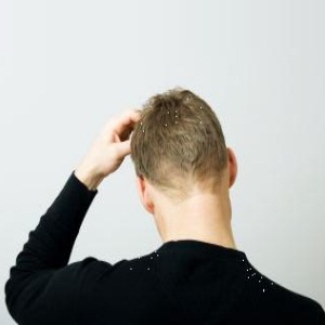 HOW TO PREVENT DANDRUFF AND HAIR FALL