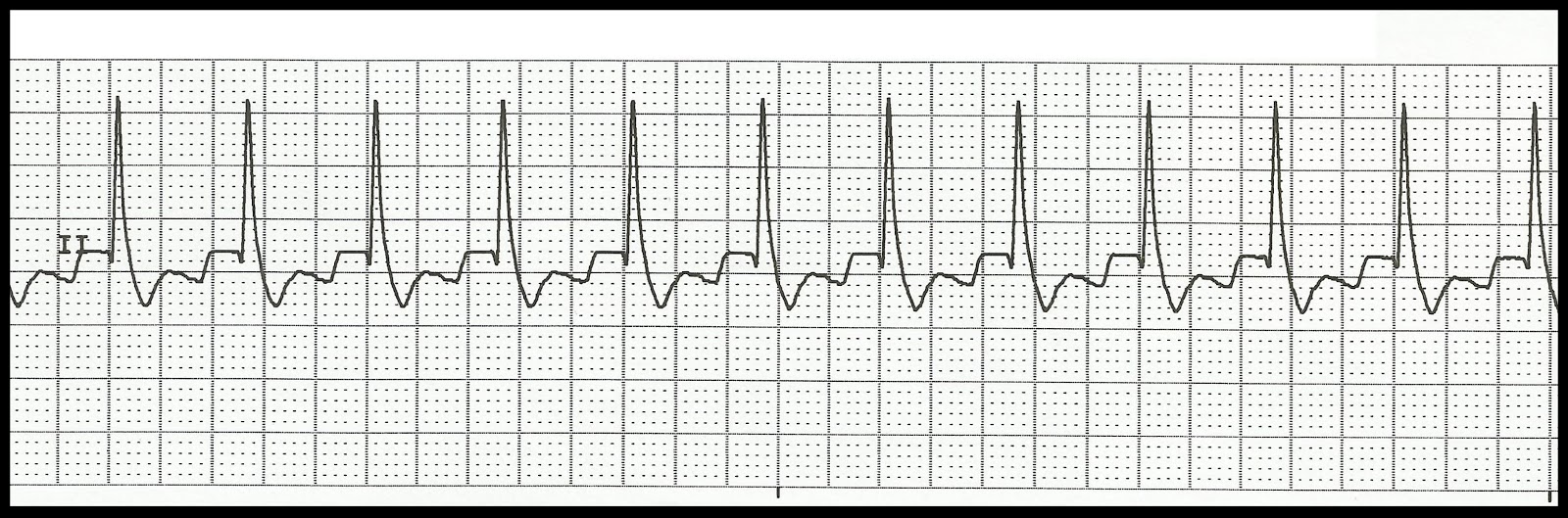 EKG Rhythm Strip Quiz 151