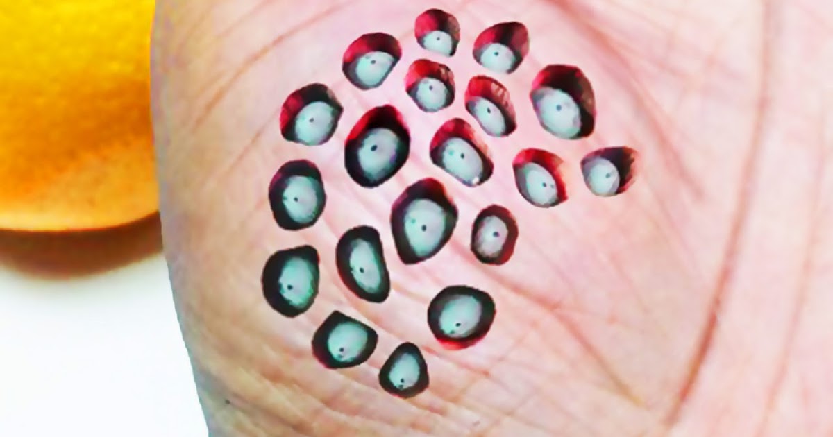 Apa itu Penyakit Trypophobia ? Inilah Penjelasan dan Cara Mengobatinya - Zona Bangka Belitung ...