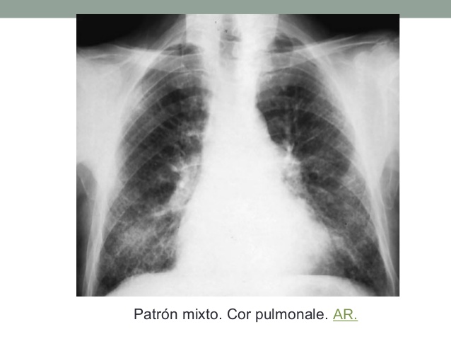 Cor pulmonale PDF