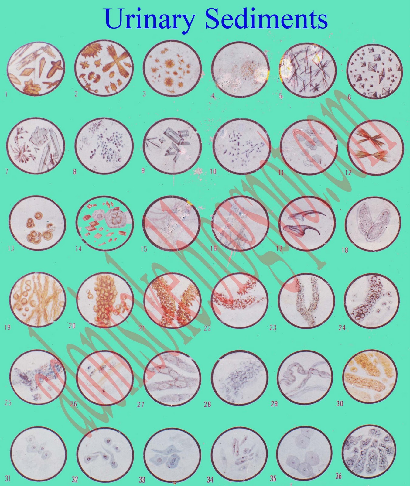 Blog Mas Ao: Gambar Sedimen Pada Urine (Urinary Sediments)