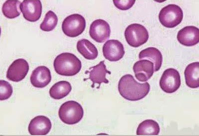 Laboratorio Clínico: Morfología anormal de los eritrocitos.