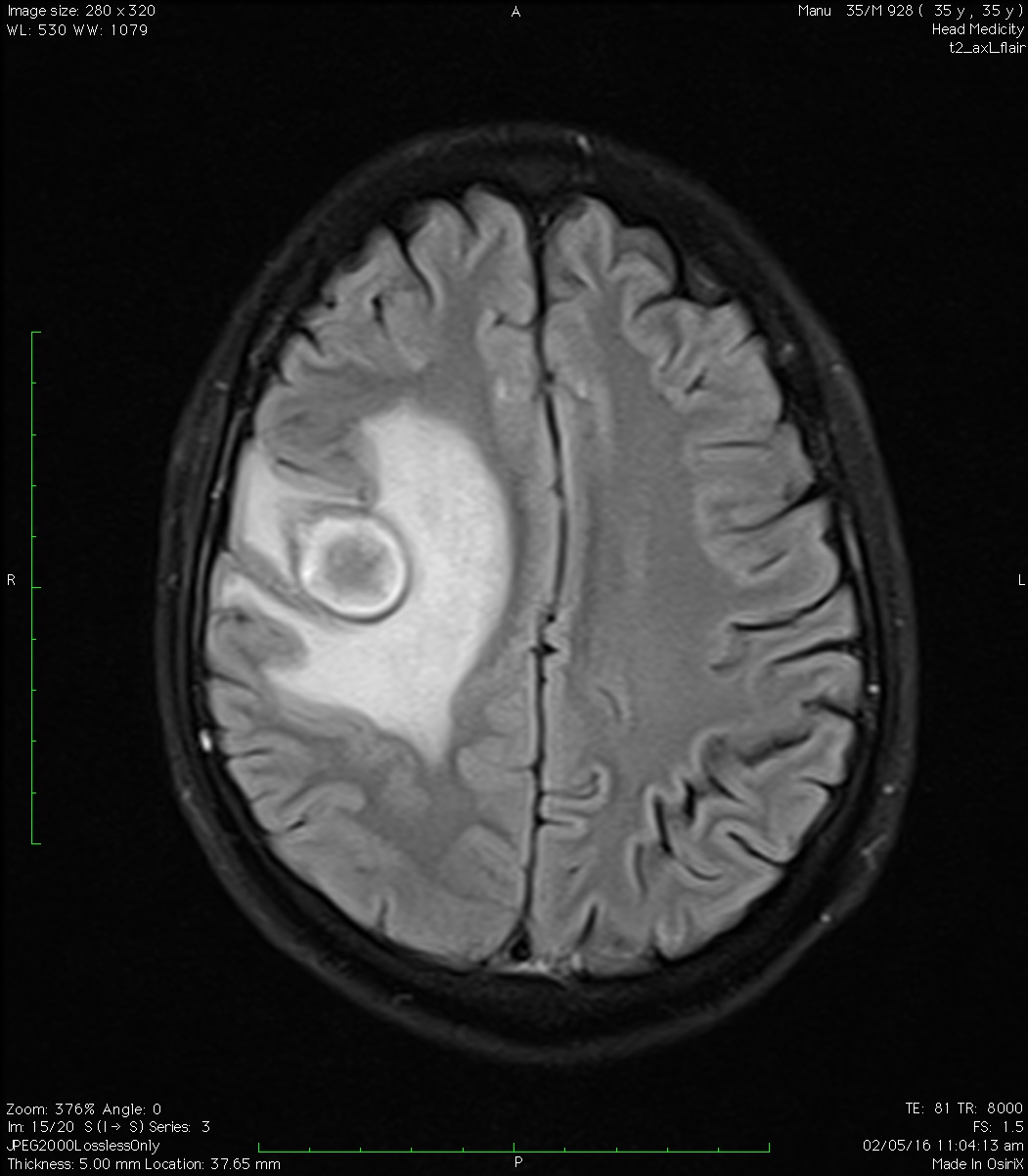 Ultimate Radiology : Frontal lobe abscess : follow up MRI