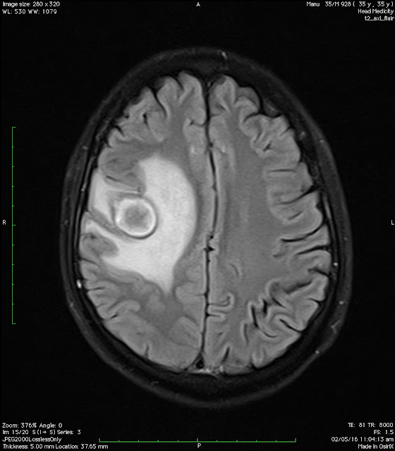 Ultimate Radiology : Frontal lobe abscess : follow up MRI