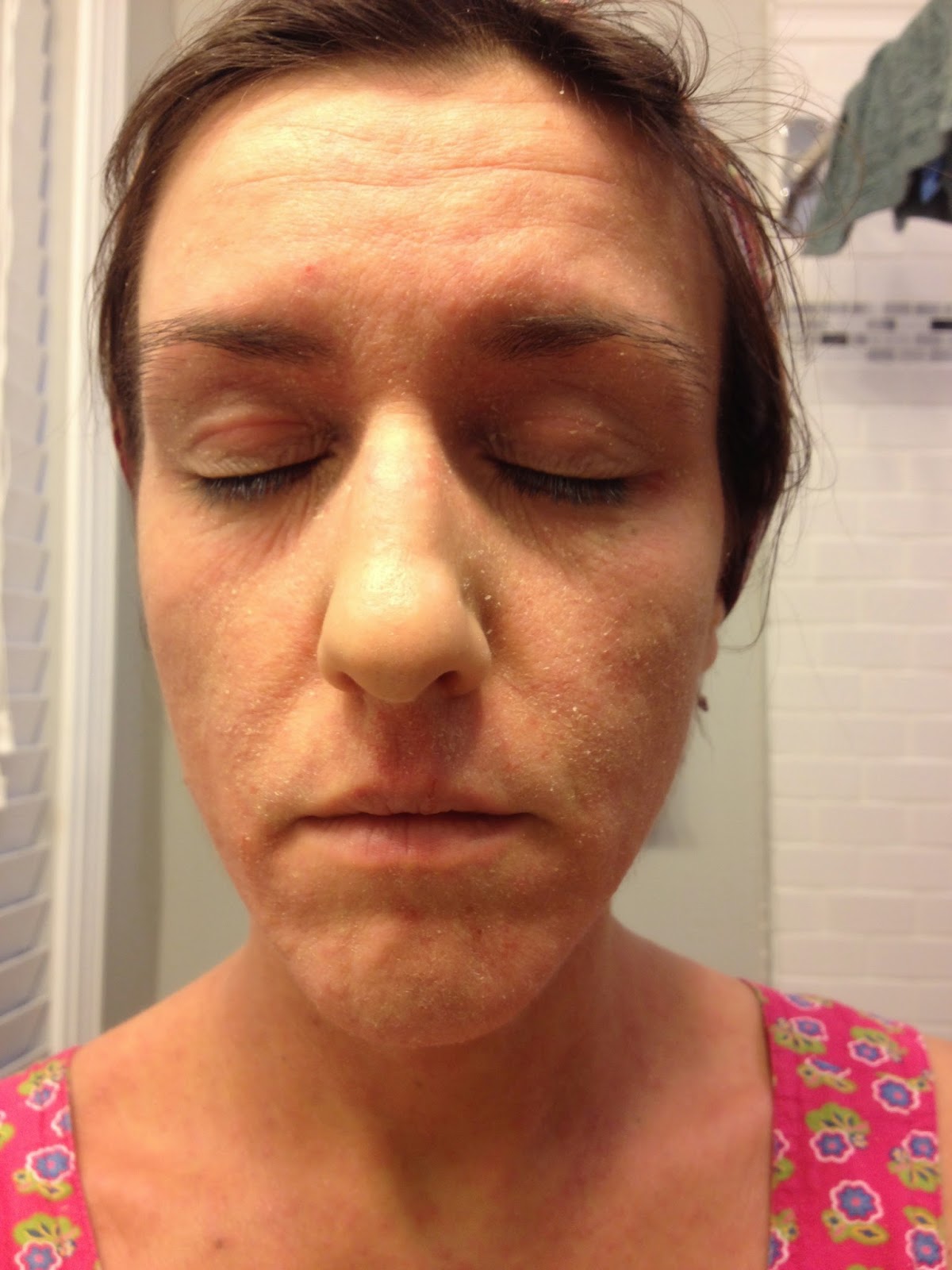 My journey with itchy skin.