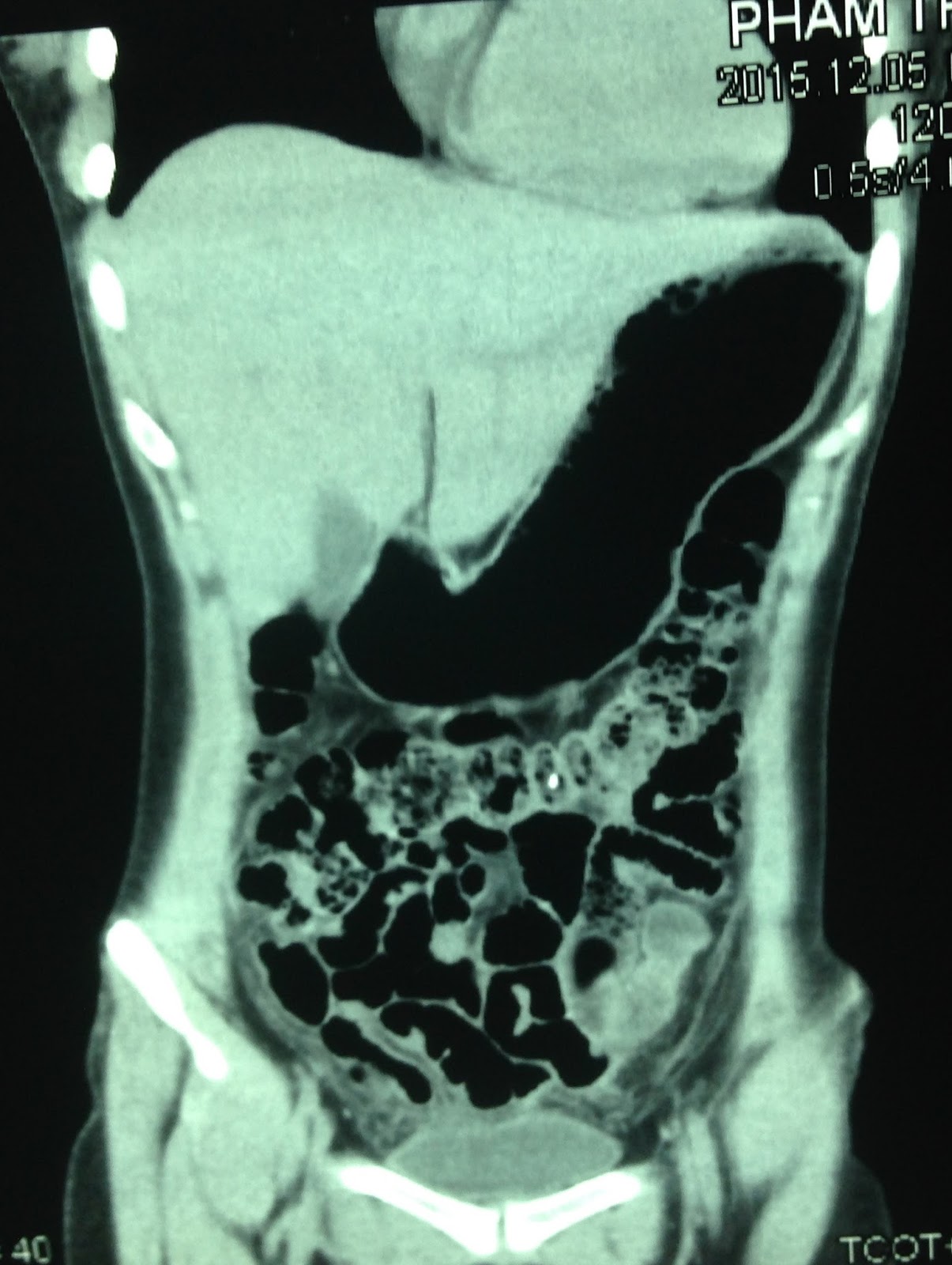 VIETNAMESE MEDIC ULTRASOUND: CASE 351:A CASE of FITZ-HUGH-CURTIS ...