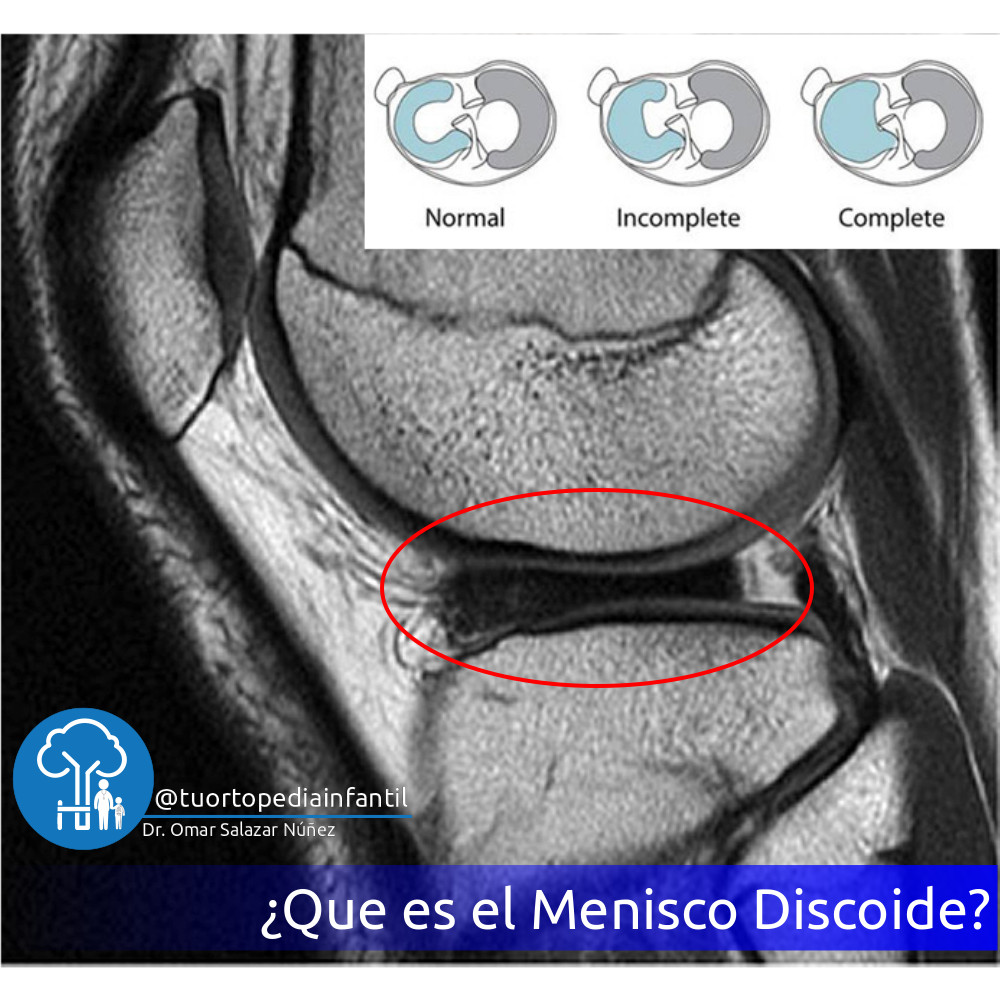 ¿Que es el menisco discoide?