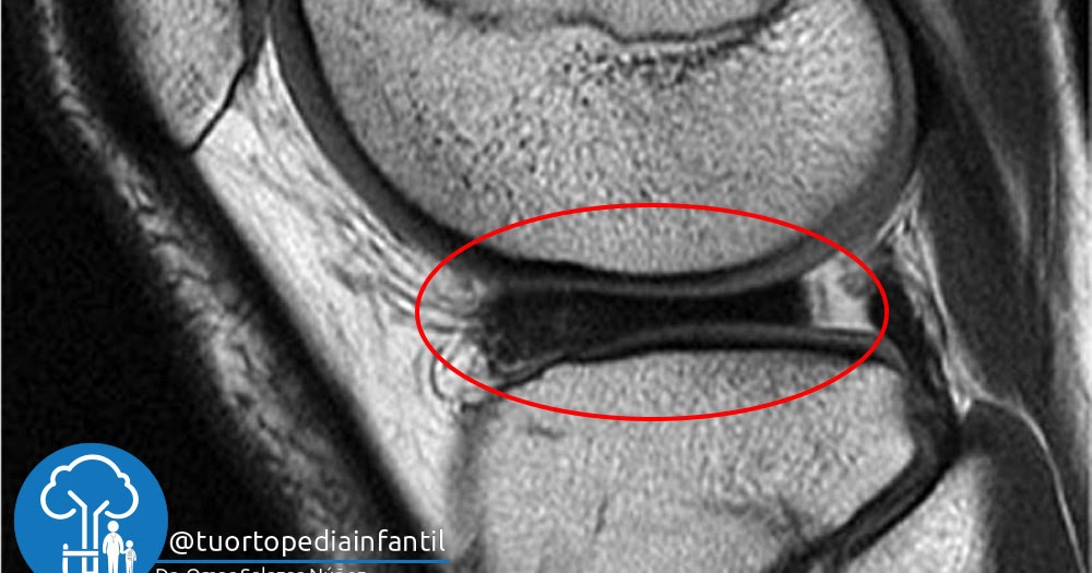 ¿Que es el menisco discoide?
