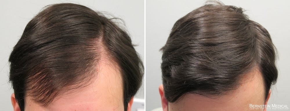 Rawatan Rambut Gugur Dermatologis: BEFORE & AFTER RESULT - BERSTEIN MEDICAL