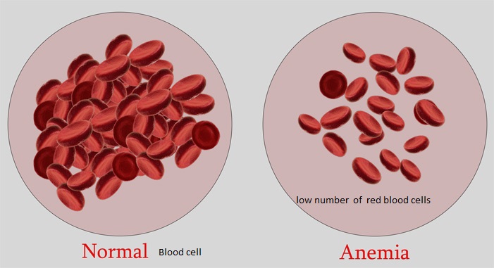 Anemia-Low Red Blood Cells
