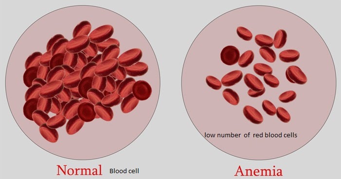 Anemia-Low Red Blood Cells