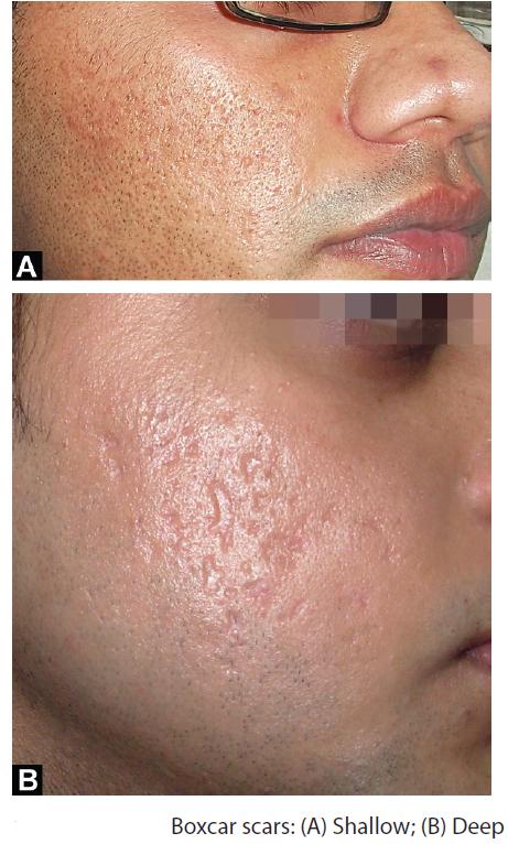 Morphological Types of Acne Scars - Treatment of Acne Scars