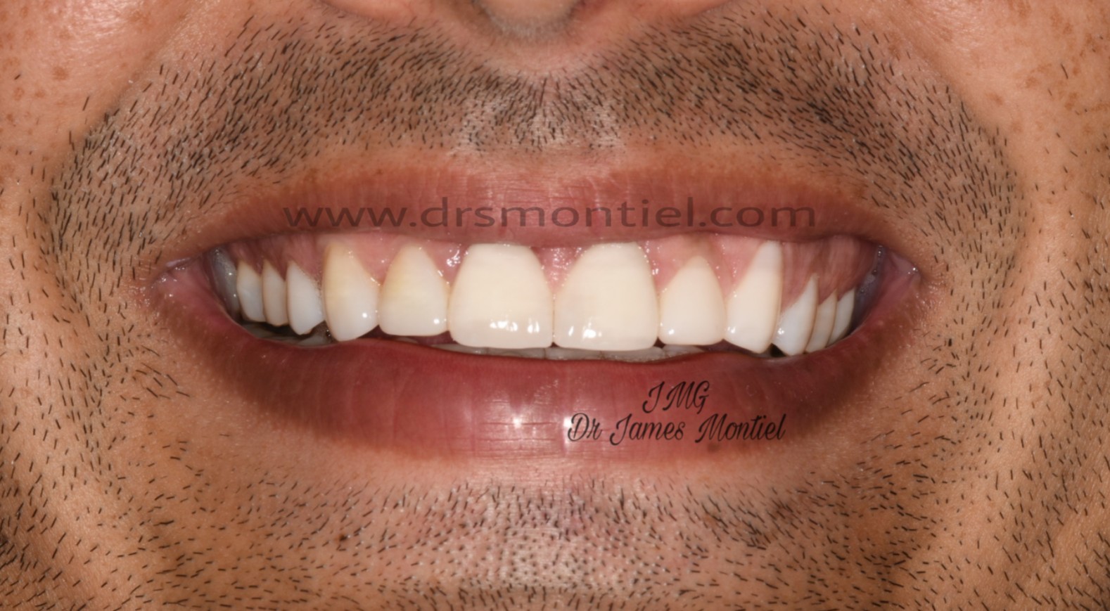 Botox, Acido Hialurónico, Bichectomia, Invisible Touch Hilos Pdo