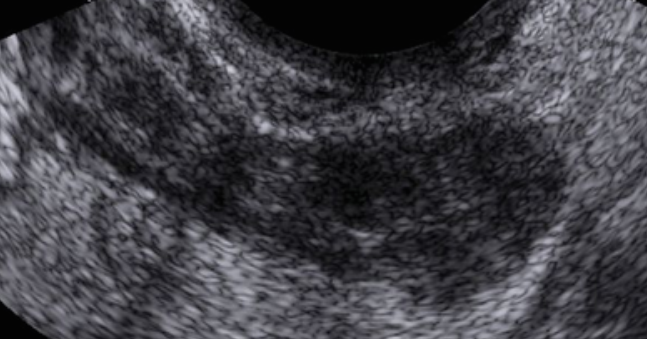 Pelvic Inflammatory Disease and Tubo-Ovarian Abscess