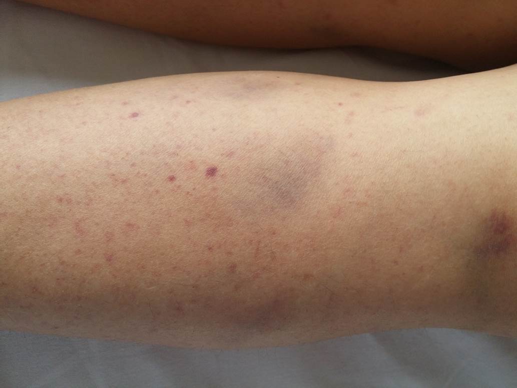 Residentes Medicina Interna HNERM: CASO CLINICO HEMATOLOGIA