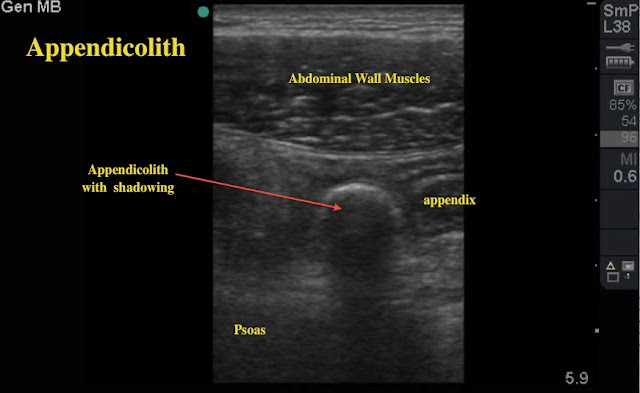 Ultrasound for Appendicitis ~ Ultrasound Cases Info