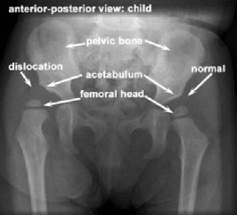 Dysplasia Developmental of the Hip (DDH) Bagian 2