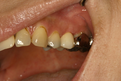 Drなるとのブログ: フルジルコニアクラウンの制作過程 FCZ Crown: Full Contour Zirconia Crown ,KATANA