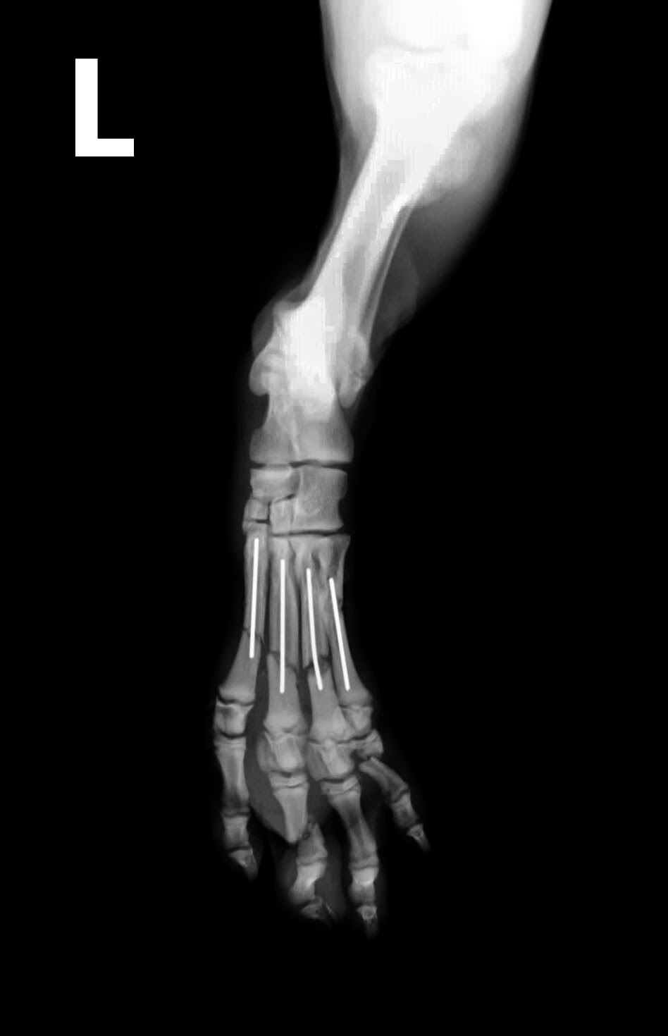 ARTROVET: Fractura de metatarsos