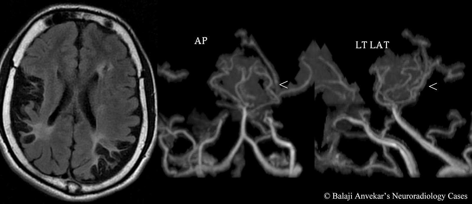 Dr Balaji Anvekar FRCR: Moyamoya Disease MRI