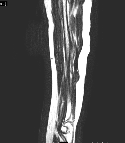 Retained Broken Injection Needle-MRI - Sumer's Radiology Blog
