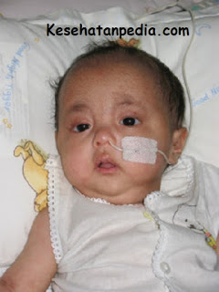 Indikasi Pemasangan NGT pada Bayi - kesehatanpedia