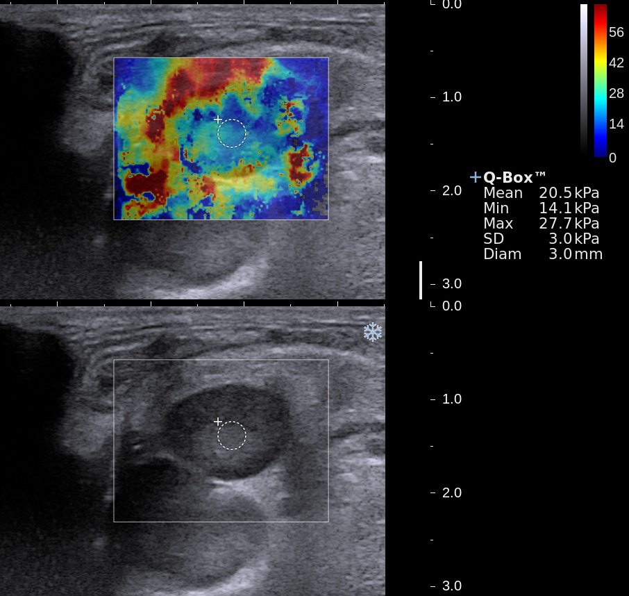 VIETNAMESE MEDIC ULTRASOUND: CASE 470: TROISIER-VIRCHOW NODES, Dr PHAN ...