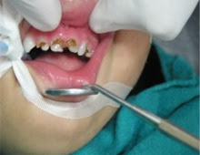 ~M@M@ T0t0!~: Karies Botol Susu