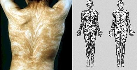 ¿Qué son las líneas de Blaschko? ~ El Médico Contesta