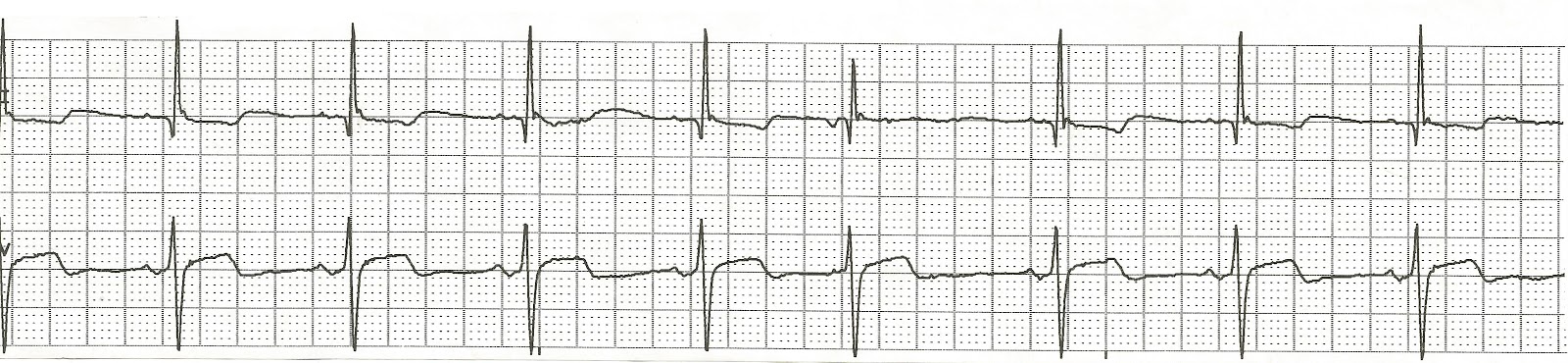 EKG Rhythm Strip Quiz 78