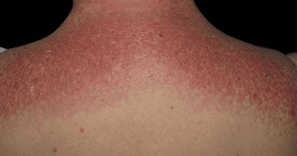 Dermatomyositis Shawl Rash