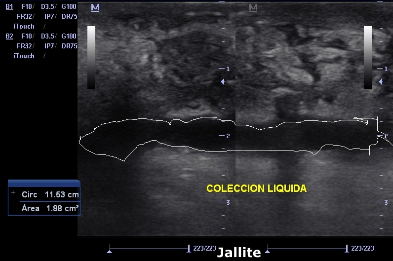 Edema Celular Sub-Cutaneo