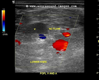 cochinblogs: Ultrasound imaging of popliteal vein thrombosis