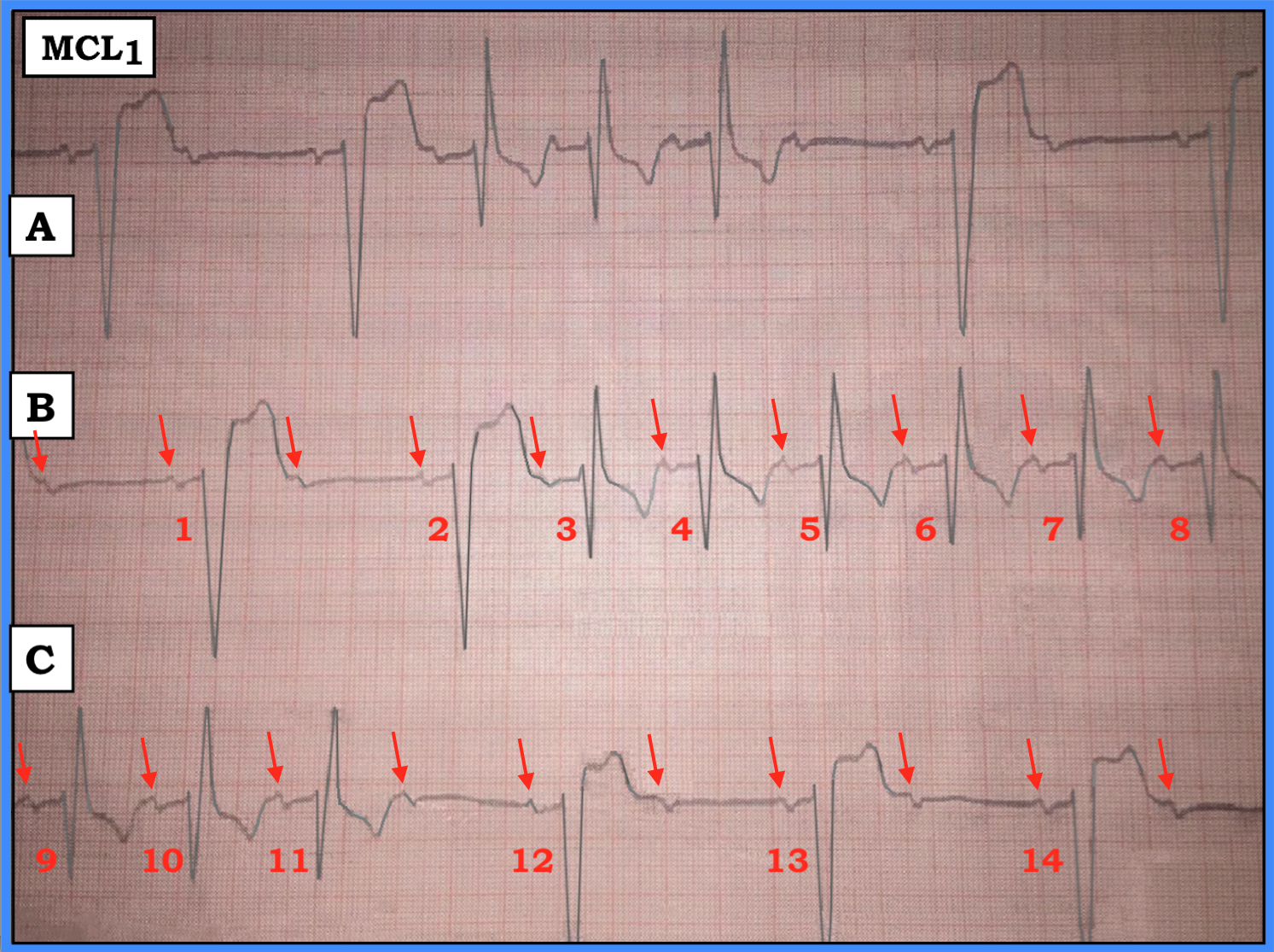 ECG Interpretation