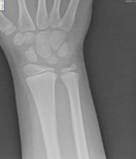Scapholunate Dislocation-Plain Film - Sumer's Radiology Blog