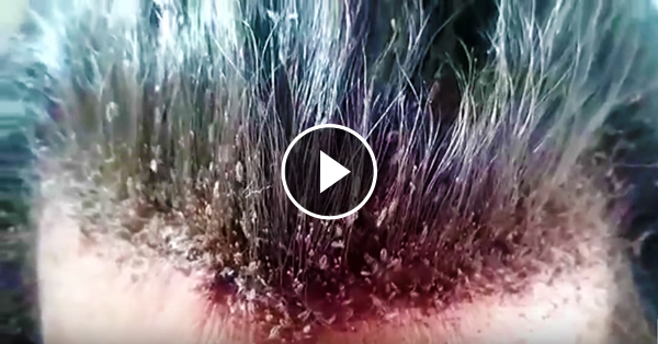 This Is The Most Horrific Head Lice Infestation! It Will Make Your Skin ...