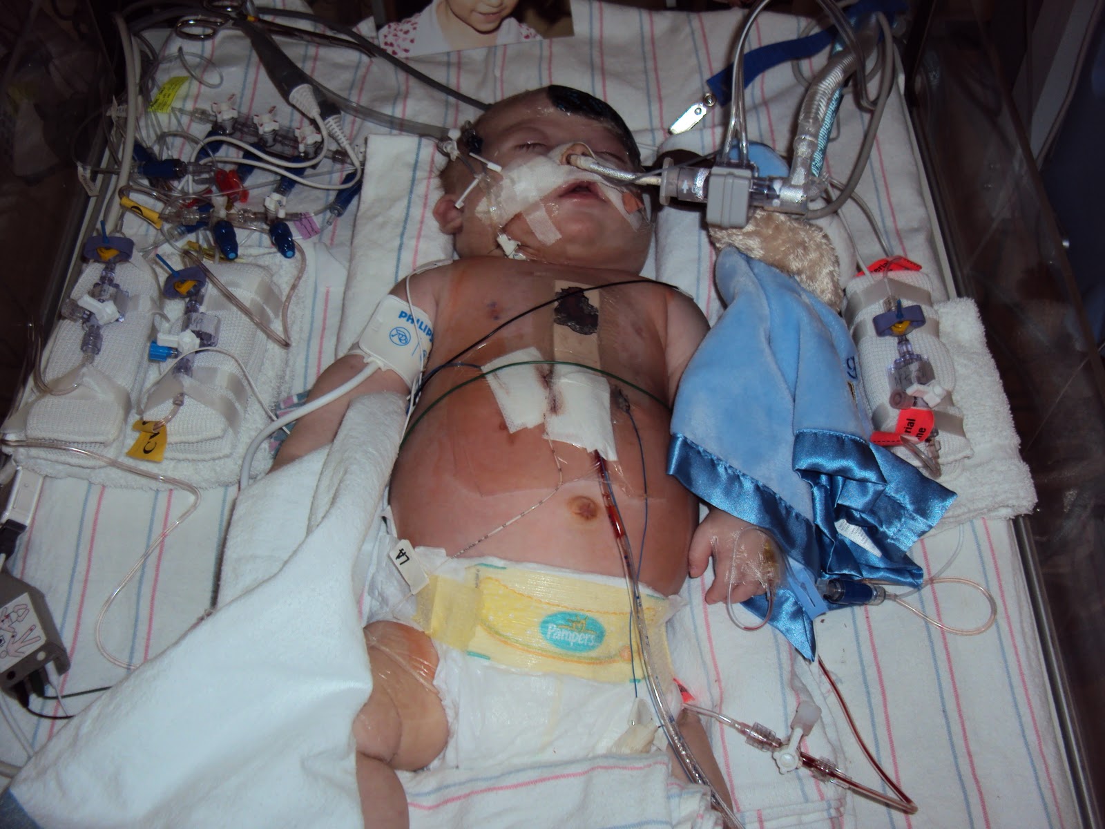 The Murphy Family Adventures: Day 5 - Open Heart Surgery