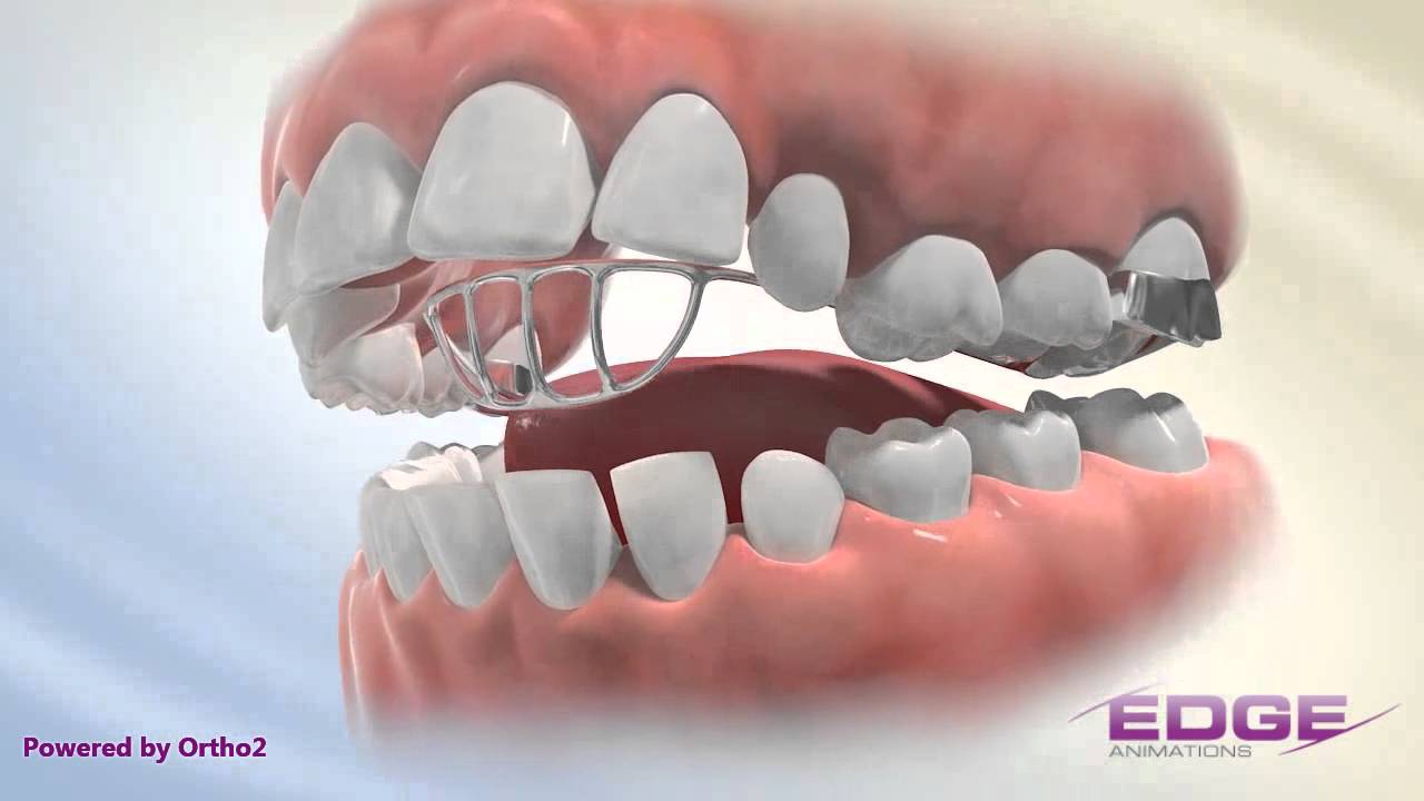 How I Survived Impacted Canines As An Adult: Initial Ortho Visit