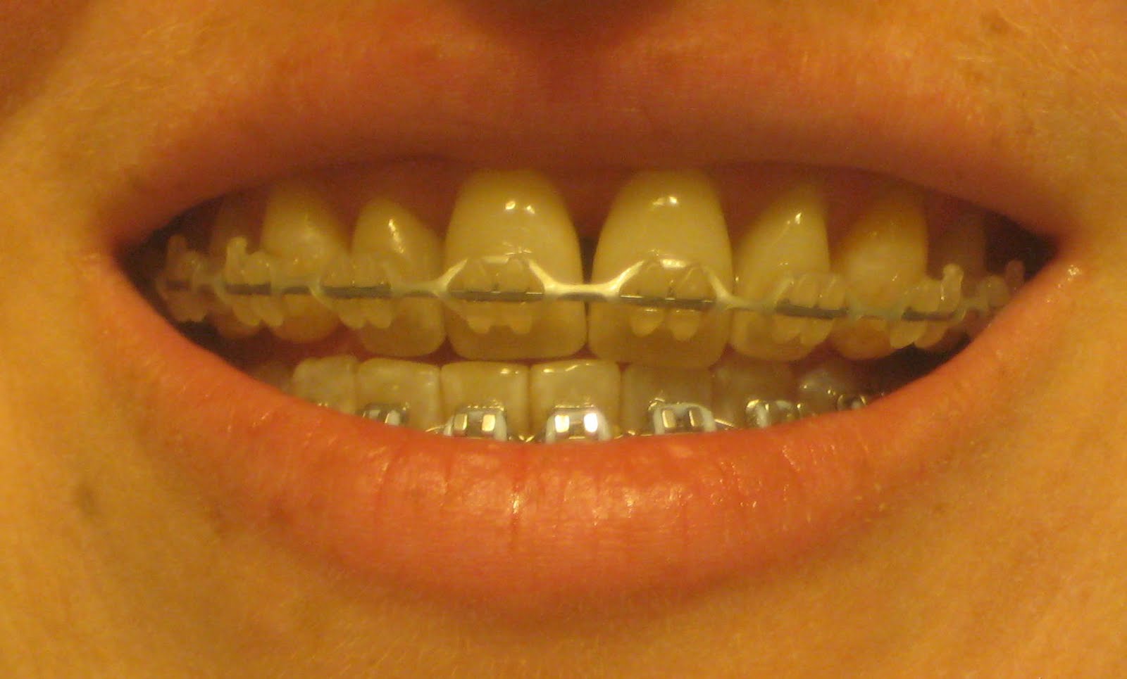 SARPE, Jaw Surgery and Adult Braces, Oh My!: Lower surgery update!