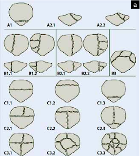 Patella Fracture Case Presentation