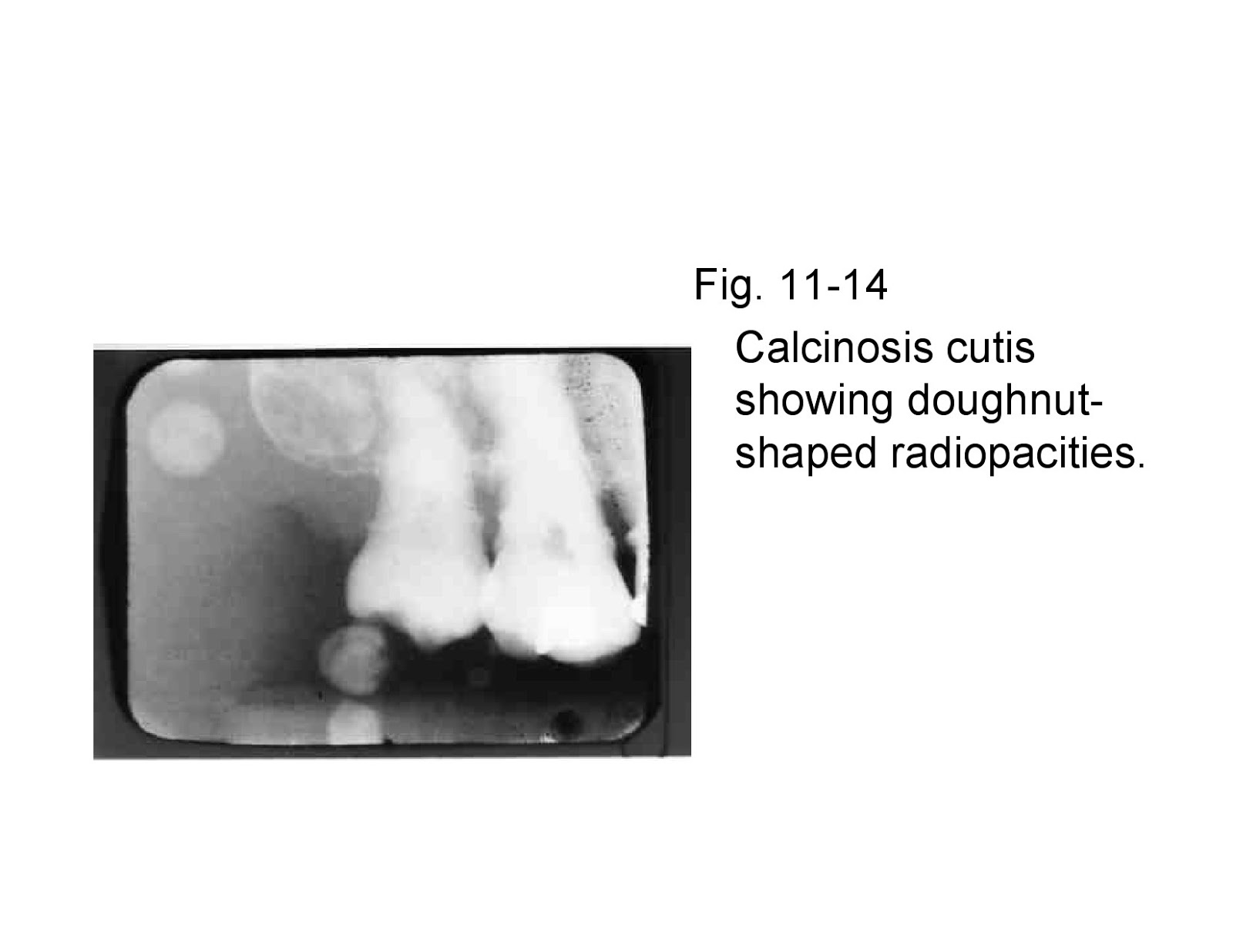 Dentistry and Medicine: SOFT TISSUE CALCIFICATIONS IN ORO-MAXILLO ...