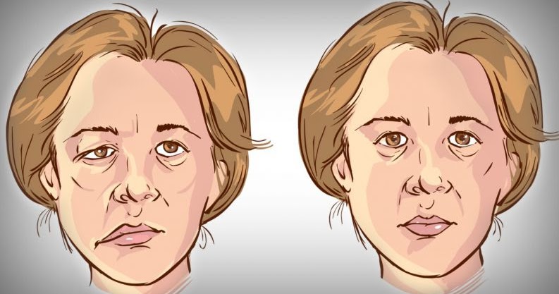 Bell's Palsy - Causes, Symptoms and Treatments - InfoSchool